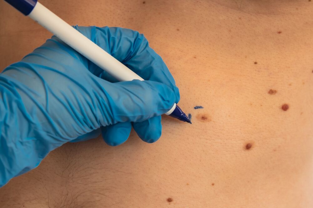 How To Minimize and Reduce Skin Cancer Scars - Arizona Premier Surgery